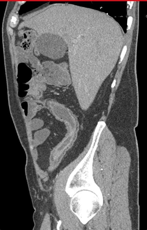 Ischemic Colitis Ct Angiogram At Willard Madrigal Blog