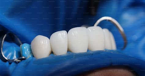 클리닉 클로즈업에 베니어판과 치과용 임플란트 설치 치과 보철 개념 사진 Unsplash의 건강한 라이프스타일 이미지