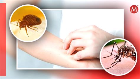 Ésta Es La Diferencia Entre Picaduras De Chinche Y De Mosquito Grupo