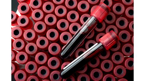 A Revolutionary Blood Test Offers Hope In Colorectal Cancer Screening