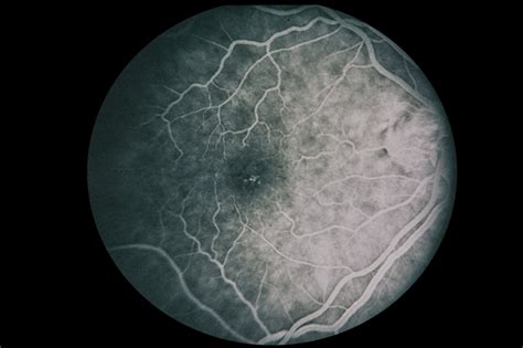 Cystoid Macular Edema CME Retina Image Bank