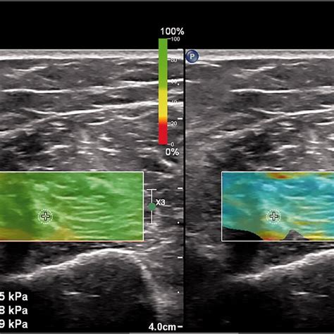 Long Axis View Of Radial Nerve Shear Wave Elastography Confidence Map