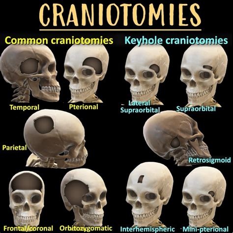 Craniotomy And Brain Surgery Complications What To Expect