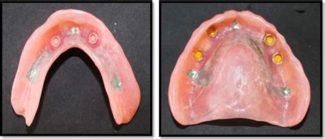 Individual Implants Retained Maxillary And Mandibular Overdentures With Limited Vertical And