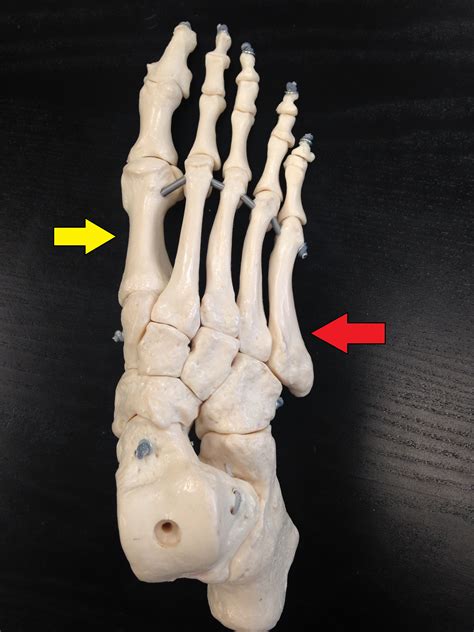 Foot Bones Jones Fracture Northern InStride Foot Ankle Specialists