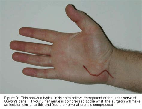 Ulnar Nerve Surgery