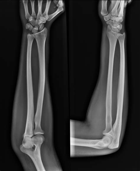 Forearm X Ray Labeled At Thad Herdon Blog