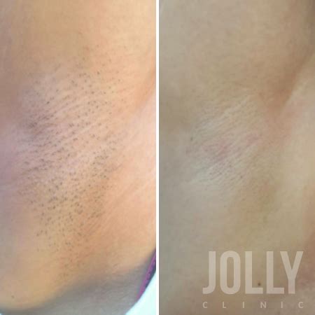 Лазерная эпиляция подмышек от 1800 руб Jolly Clinic Москва