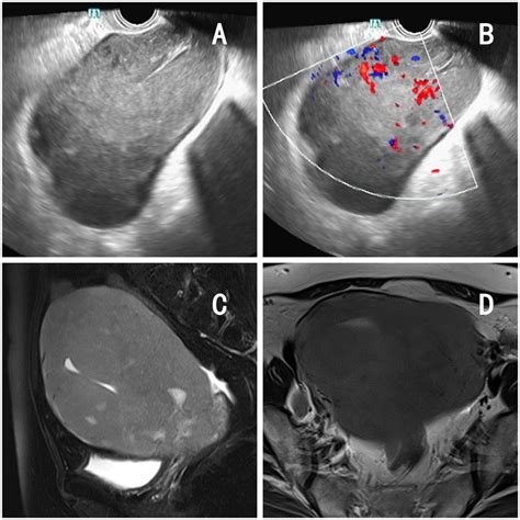 Figure E Imaging Findings Of The Patient A B Pelvic Ultrasound A