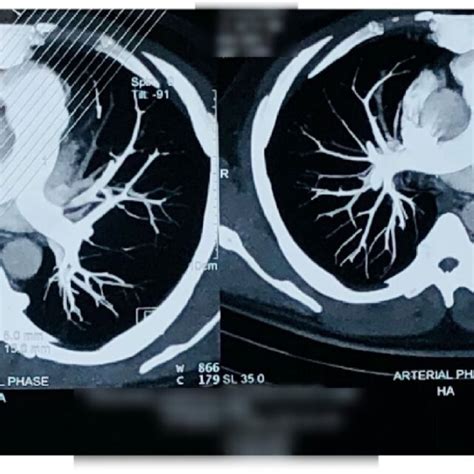 Follow Up Ctpa Showing Resolution Of Previous Contrast Filling Defect