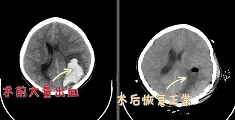 医疗资讯儿童头痛呕吐不止 警惕脑血管破裂