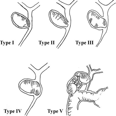 Schematic Representation Of The Csendes Classification For Mirizzi