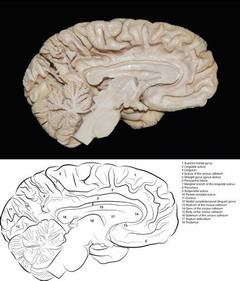Subparietal Sulcus Subparietal Sulcus