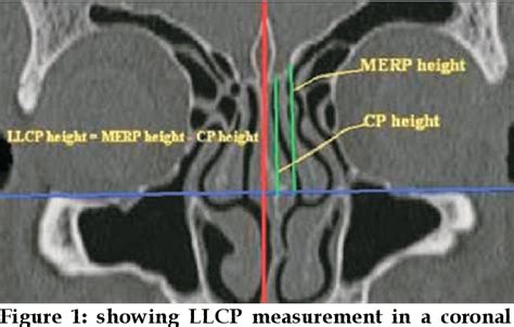 Figure 1 From Assessment Of Olfactory Fossa Depth Based On Keros