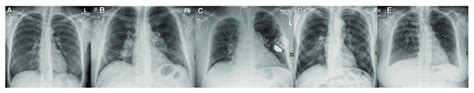 Scadding Stages Of Intrathoracic Sarcoidosis A Stage 0 No Disease