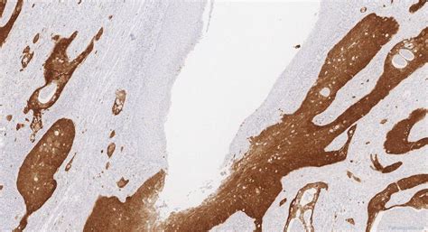 Hpv Associated Squamous Cell Carcinoma Of The Eye Ottawa Atlas Of