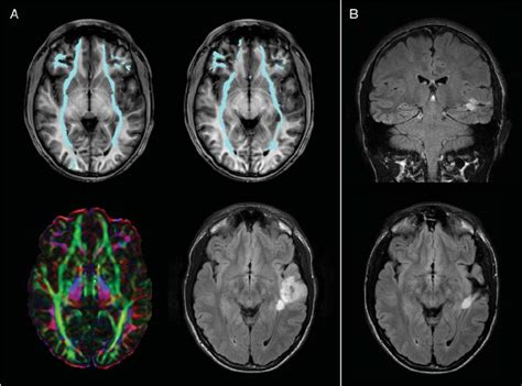 A A Case Of A Left Temporal Oligodendroglioma With A Deep Nodule