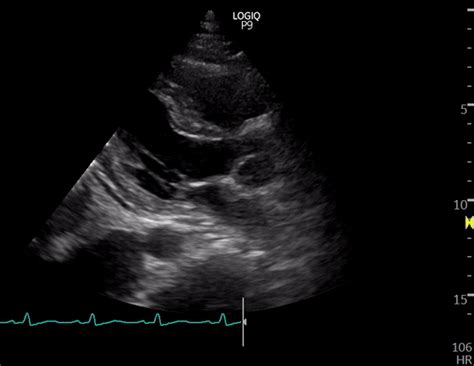 Pulsatile Vessel Carotid Artery Or Internal Jugular Vein Nephropocus