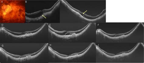 A 66 Year Old Woman With An Axial Length Of 28 63 Mm Myopic Choroidal
