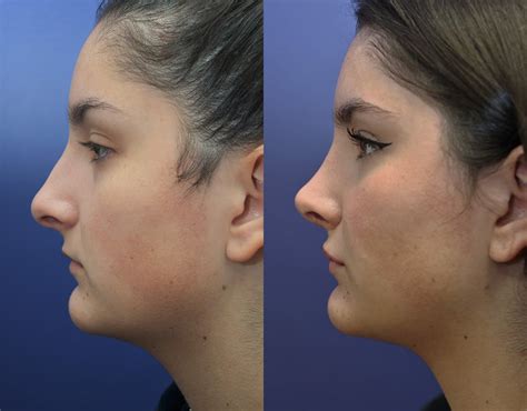 Patient 144711158 Lip Augmentation Gallery Tansavatdi Facial