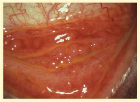 Conjunctival Follicles