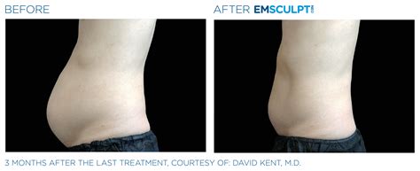 Emsculpt Neo More Muscle Less Fat — Rejuve Medspa Newcastle Near