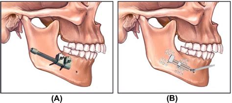 Figure 1 From Two Axis Continuous Distractor For Mandibular