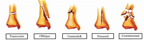 Types Of Bone Fractures And Difference Between Fracture Dislocation And Sublaxation