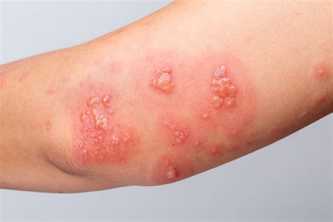 Herpes Zóster O Que é Sintomas Causas E Tratamento Imunovida