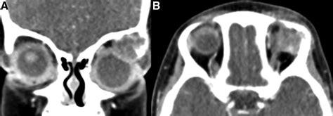 Aneurysmal Bone Cyst Of The Orbit With Usp6 Gene Rearrangeme