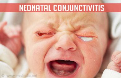 Neonatal Conjunctivitis Causes Symptoms Diagnosis Treatment