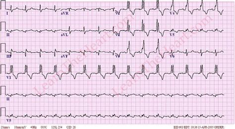 Right Bundle Branch Block Ecg 2