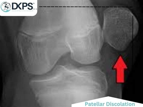 Patella Discolation Drsinghphysiocare
