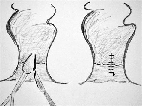 Fergusons Closed Hemorrhoidectomy The Hemorrhoid Is Grasped Using A Download Scientific