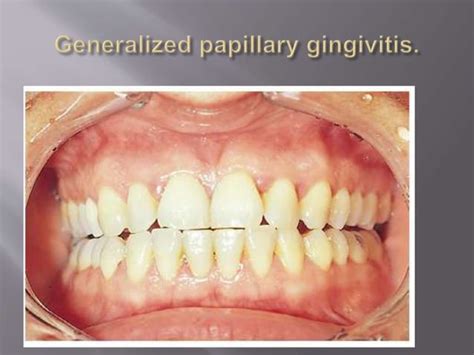 Clincial Features Of Gingivitis Ppt