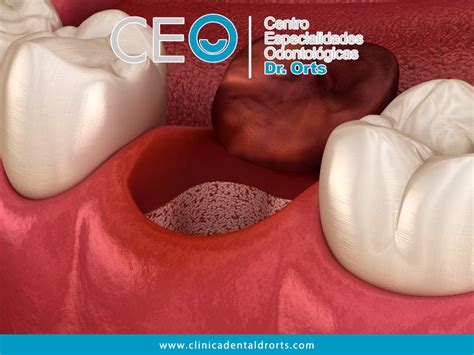 Alveolitis Dental