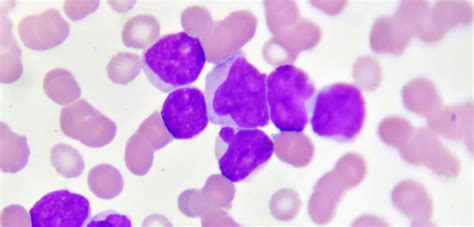 Acute Lymphoblastic Leukaemia How Is It Different To Acute Myeloid