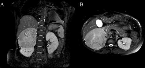 Coronal A And Transverse B Pelvic Magnetic Resonance Imaging
