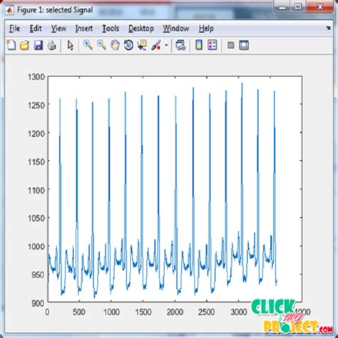 Real Time Classification Of Healthy And Apnea Subjects Using Ecg Signals With Variational Mode