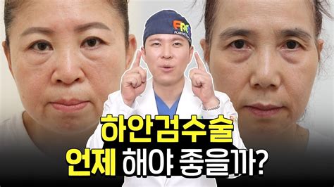 하안검 몇살에 효과적인가요 하안검 연령 수술시기 흉터 재수술 나이 들어 보이는 눈 밑 고민될 때 보세요 Youtube