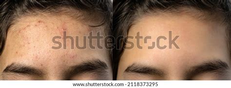 Image Compare Before After Acne Treatment Stock Photo Shutterstock
