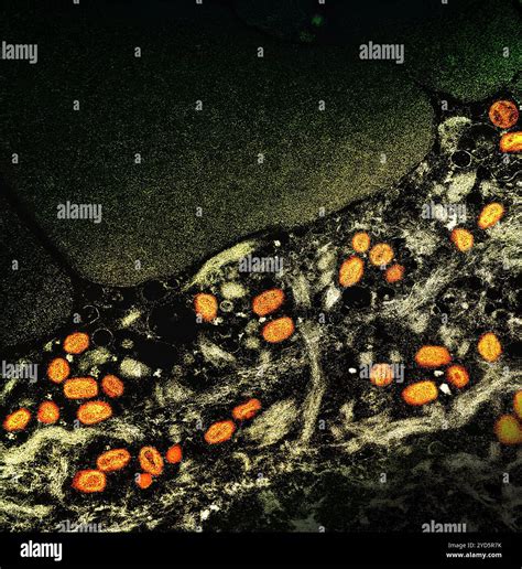 Colorized Transmission Electron Micrograph Of Mpox Virus Particles