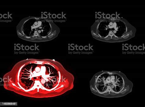 Rendering 3d Arteri Pulmonalis Cta Menunjukkan Cabang Arteri Pulmonalis