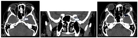 Series Of Isolated Sphenoid Disease Often Neglected But Perilous Hui