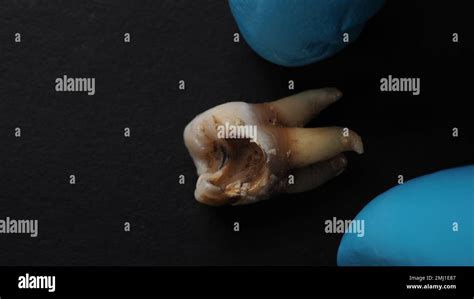 Tooth Decay And Dentist Hand With Glove And Black Background Macro