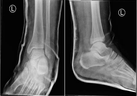 Ankle Dislocation Reduction