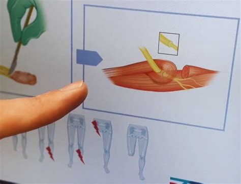 New Procedure To Prevent Phantom Pain After Limb Amputation Healthcare In Europe