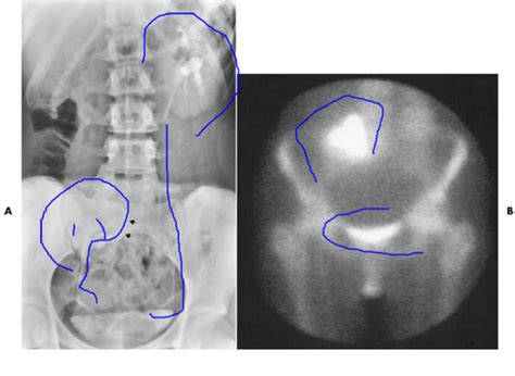 Urinary System Pathology—part A Flashcards Quizlet