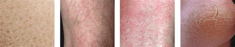 Xerosis Of Skin