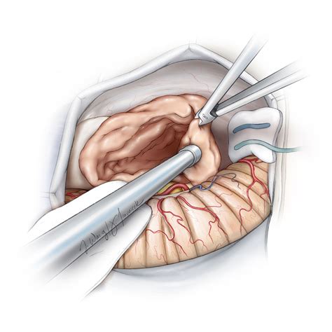 Surgery For Acoustic Neuroma Retrosigmoid Approach The Neurosurgical
